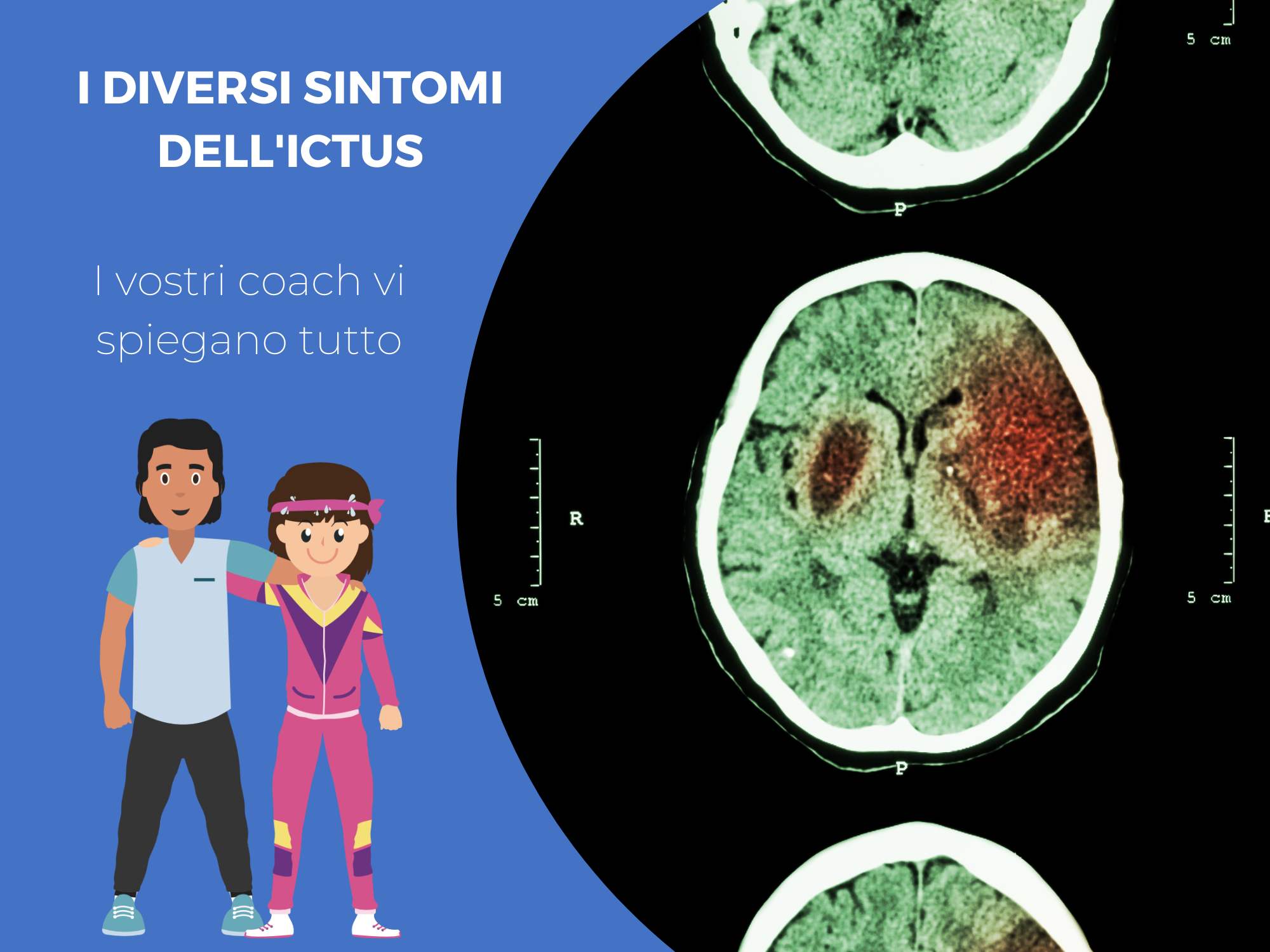 I diversi sintomi dell'ictus.